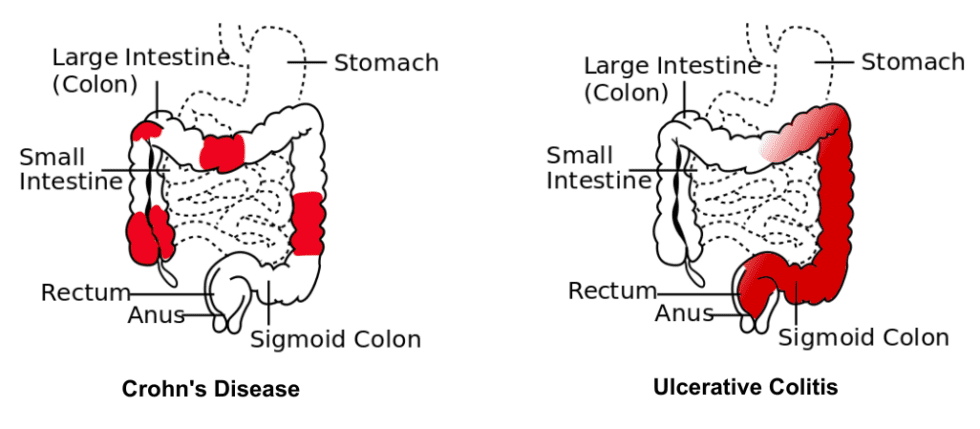 Crohn’s Disease & Ulcerative Colitis | Canadian Spondyloarthritis ...